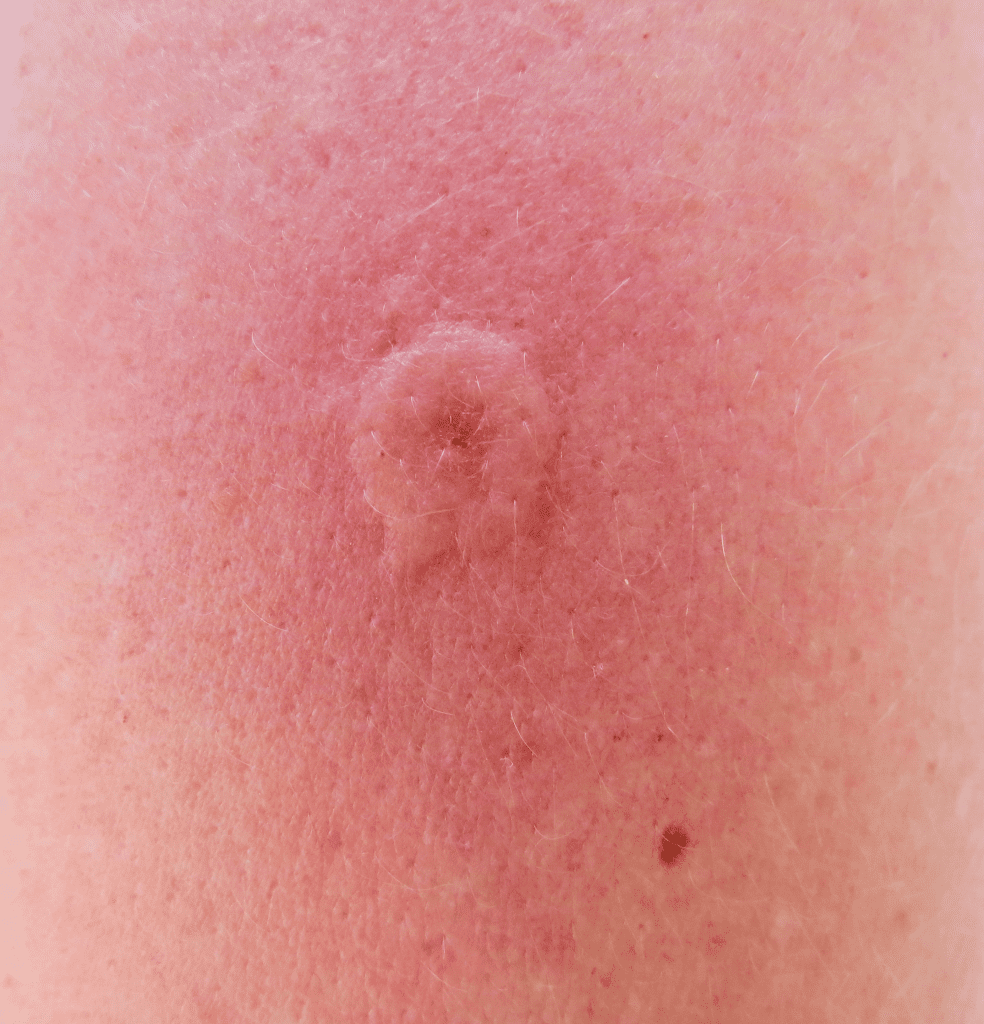 Wasp Sting | Here's What You Need To Know! | BeesWiki